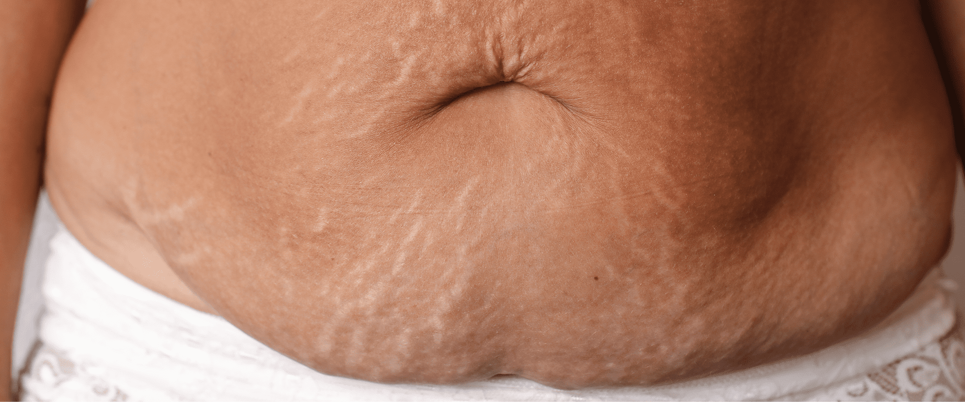 Traitements pour éliminer les vergetures qui fonctionnent vraiment | Dr ...